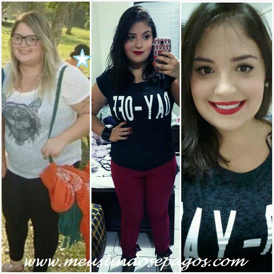Bypass Gastrico Antes E Depois